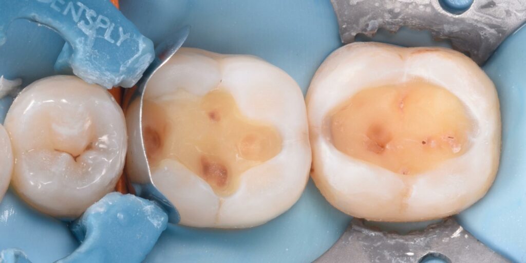 Simple Posterior Composites - Karma Dentistry