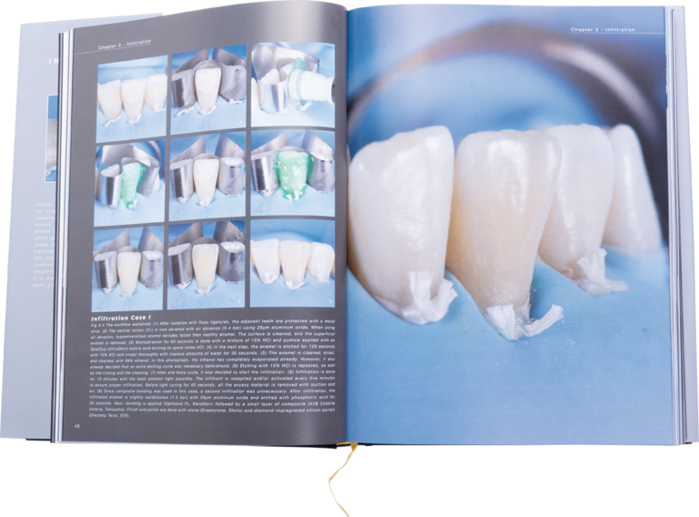 The Infiltration book - Karma Dentistry