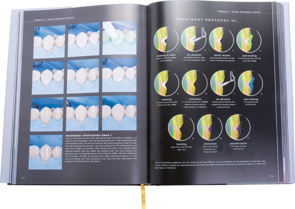 The Infiltration book - Karma Dentistry