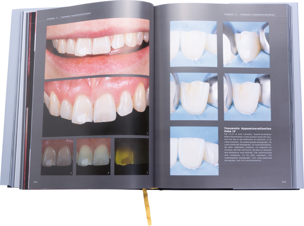 The Infiltration book - Karma Dentistry